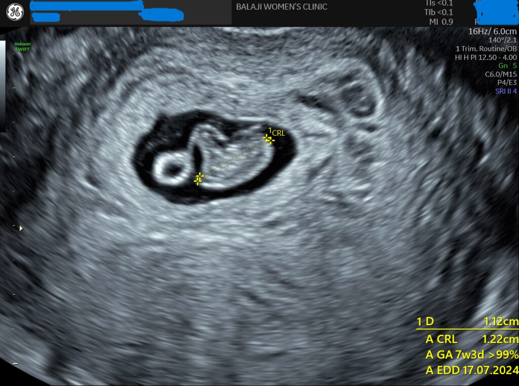 Best Viability Scan Hospital in Ahmedabad - Balaji Horizon